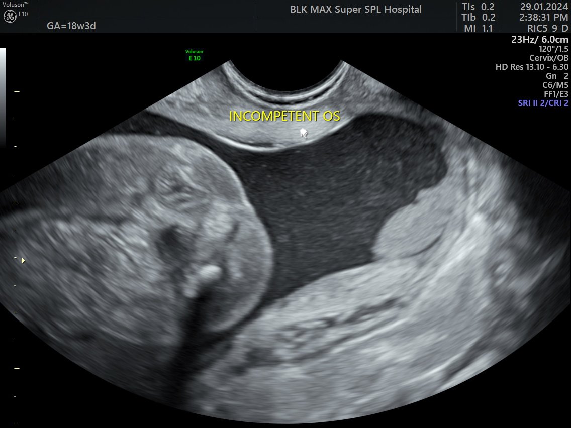 Cervical Screening – Dr. Saloni Arora