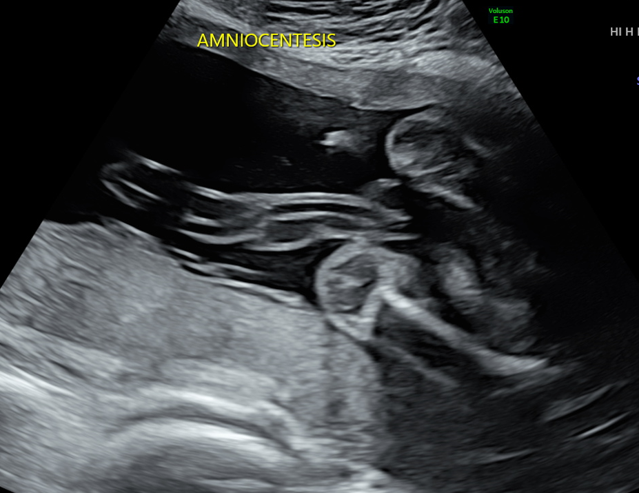 Prenatal Invasive Procedures – Dr. Saloni Arora